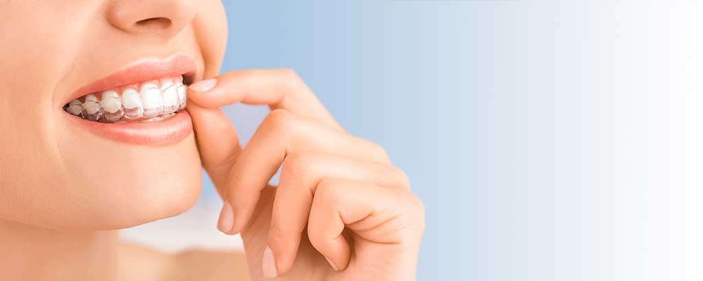 Invisalign FAQs - Creative Smiles